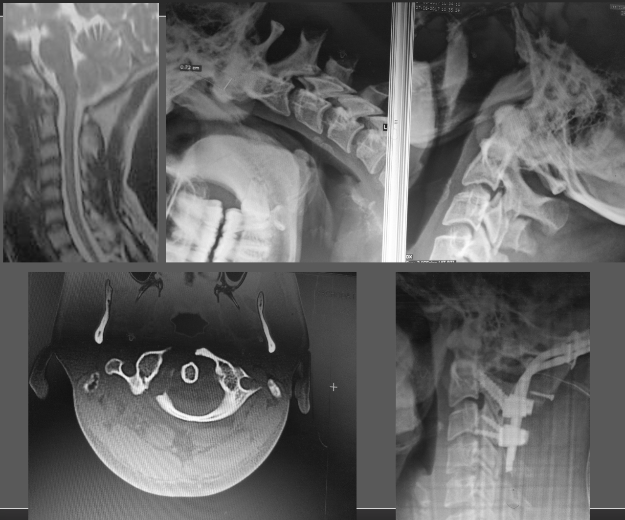 Atlas and Axis – Dr Savitr Sastri BV